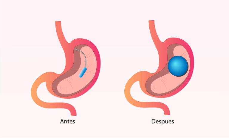 Balon Intragastrico por endoscopia - Dra. Paola Dongo